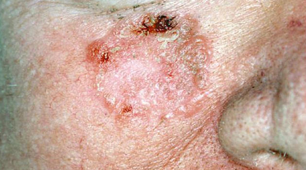 Cómo prevenir y reconocer el cáncer de piel (+fotos) - Akío Magazine