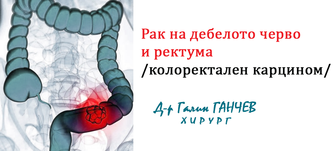 Д р Галин ГАНЧЕВ хирург Рак на дебелото черво и ректума