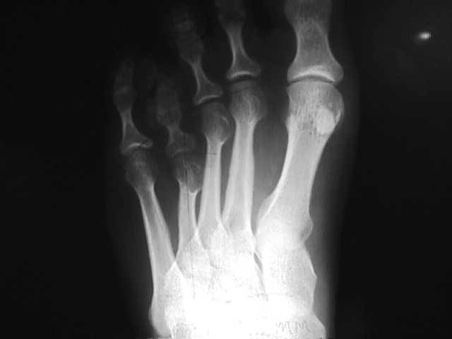 Ortopedia Pediátrica y Alargamientos Óseos: junio 2014