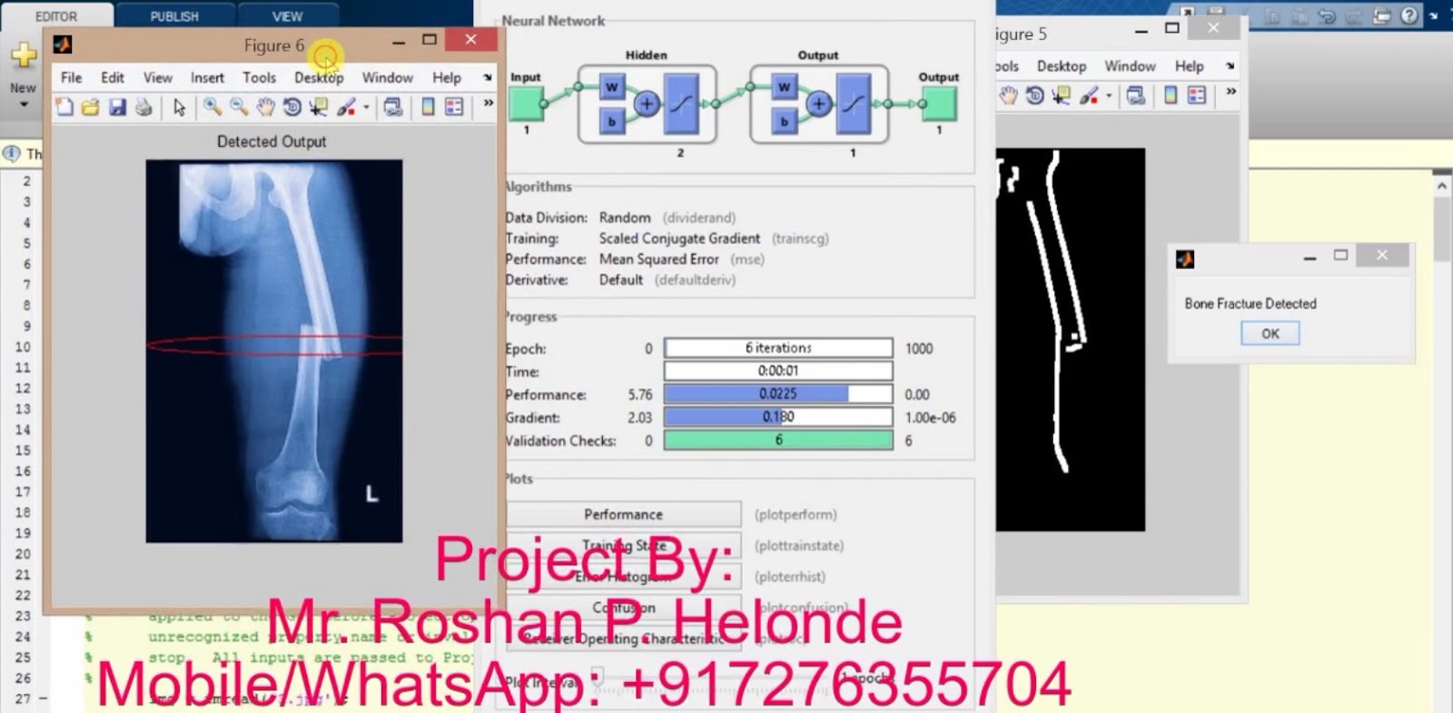 Bone Fracture Detection Using Neural Network Matlab Project With Source Code ~ Matlab Projects