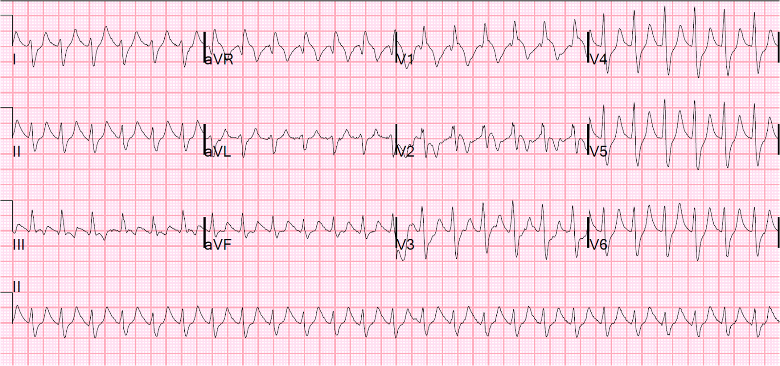 Dr. Smith's ECG Blog: Right Bundle Branch Block with ST Elevation in V1?
