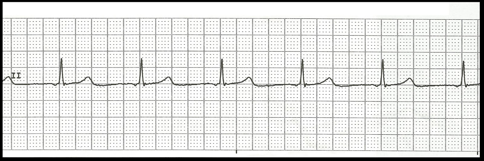 EKG Rhythm Strip Quiz 98: Junctional rhythms