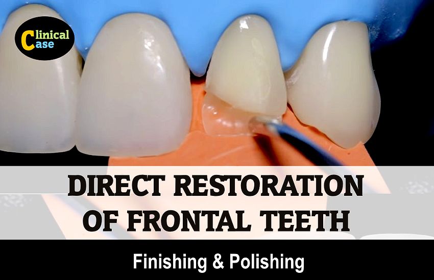 COMPOSITE RESTORATION: Direct restoration of frontal teeth - Finishing ...