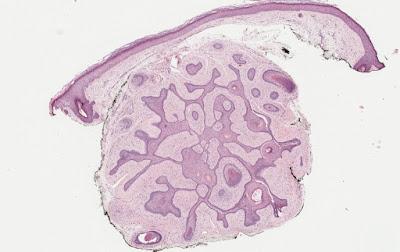 Differential Diagnosis in Dermatopathology: Follicular pathology
