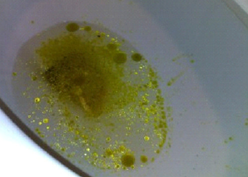 krok 2 (Gasteroenterology) with explanation part 9