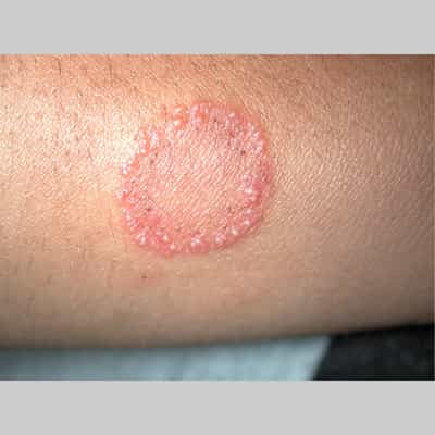 Tinea Corporis Symptoms, Causes And Treatment - Online Study