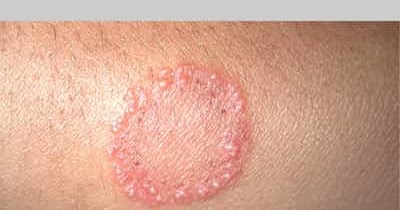 Tinea Corporis Symptoms, Causes And Treatment - Online Study