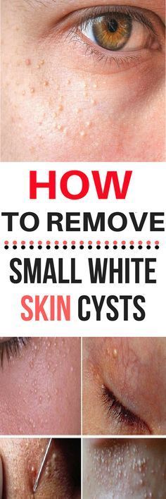 HOW TO REMOVE SMALL WHITE SKIN CYSTS (MILIA) - HEALTH CAPSULES