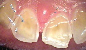 Bulimia Teeth Damage