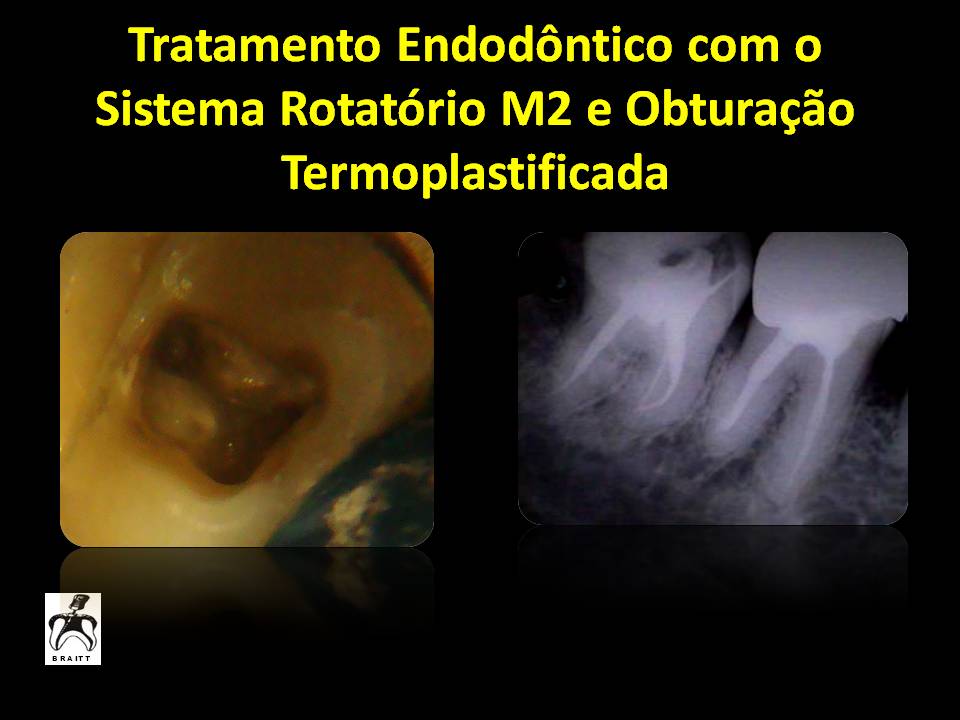 Endodontia Dr. Henrique Braitt: Tratamento endodôntico no dente 48 ...