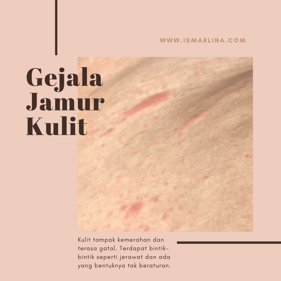 Pengalaman Terkena Infeksi Jamur Kulit - Marlina