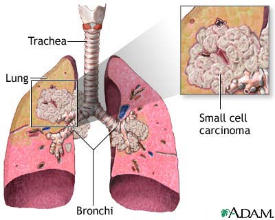 Lung cancer ~ Anatomy for MSP