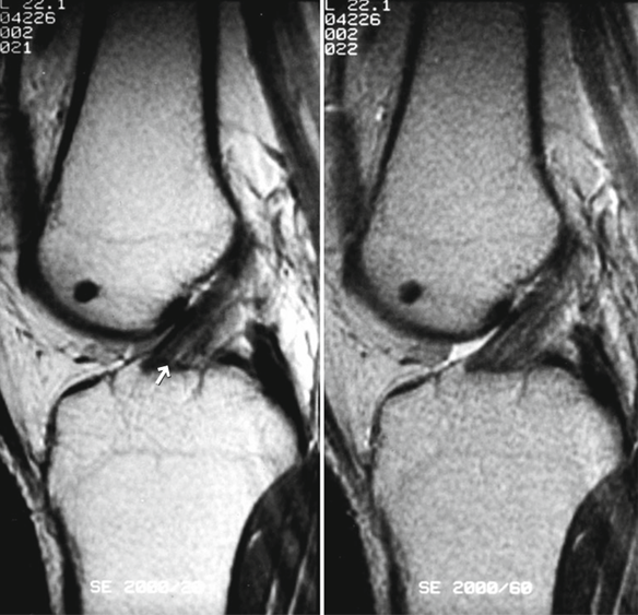 MRI Dây Chằng Chéo Trước (ACL)