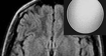ARTEFACTOS EN RESONANCIA MAGNÉTICA: ARTEFACTO DE TRUNCACIÓN: GIBBS ...