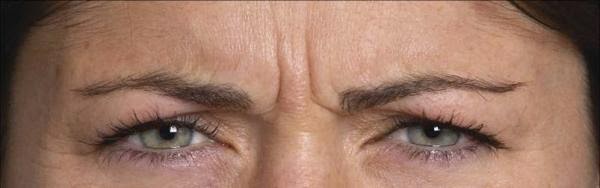 TRAITER LA RIDE DU LION ( OU DE LA GLABELLE )