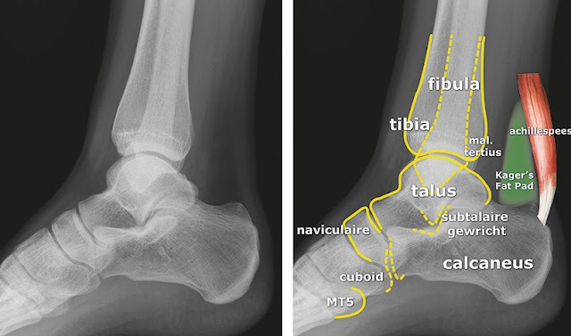 Hardlopen, trainingsmethoden: Röntgenfoto: perfecte enkel