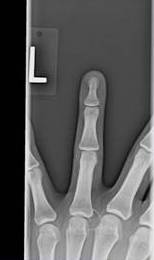 Calcific Periarthritis-Plain Film - Sumer's Radiology Blog