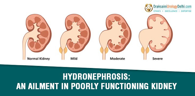 Hydronephrosis: An Ailment In Poorly Functioning Kidney