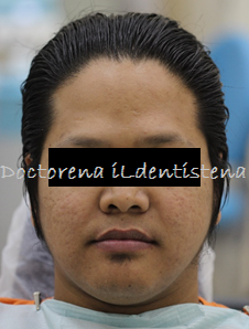 My Dental Diary: Comprehensive case 1 - Multiple edentulous areas