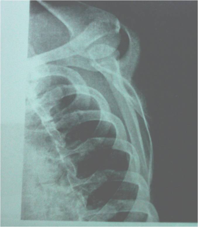 Catatan Ku: Teknik Radiografi Scapula