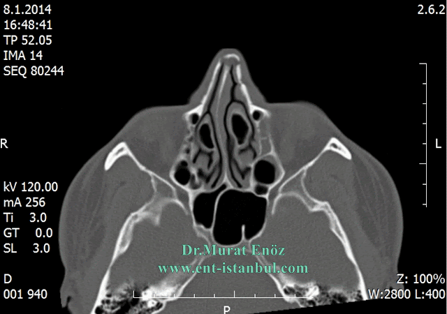Concha Bullosa - Aerated Turbinate - Definition and Treatment