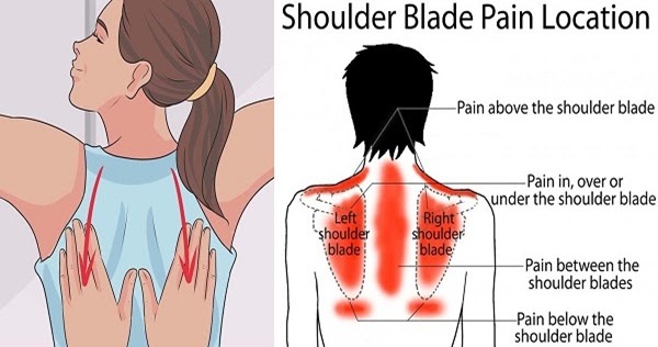 Vodič za zdravlje: Kako prepoznati da li je BOL između lopatica ...