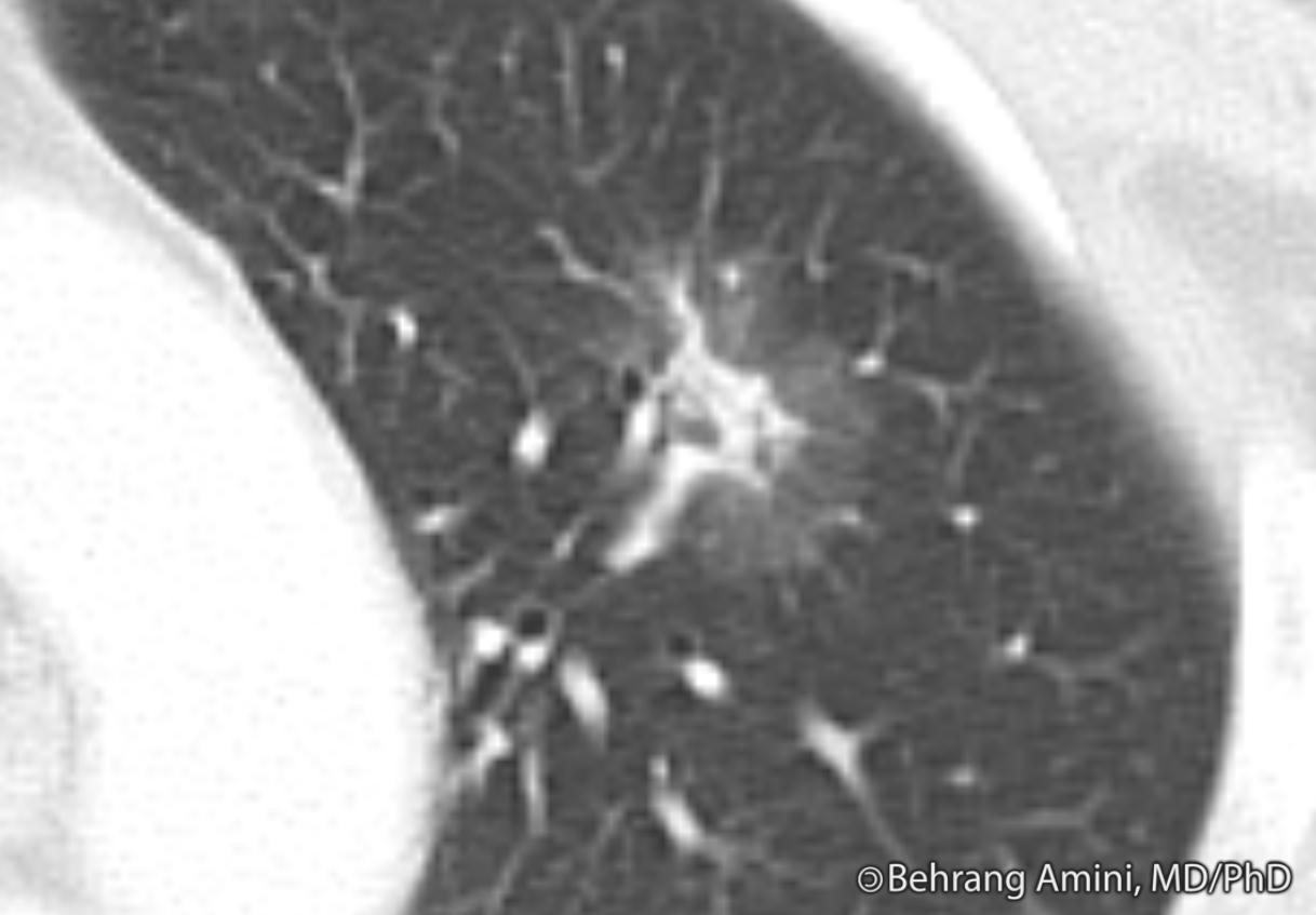 Roentgen Ray Reader: CT Halo Sign