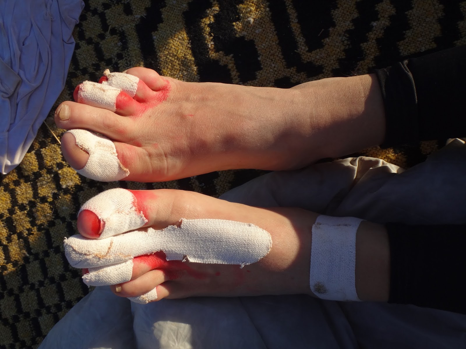 Blisters From Running On Toes Hot Sale | emergencydentistry.com