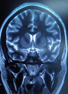 Brain death For Radiologist - Radiology Imaging