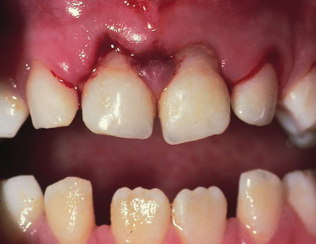Study Medical Photos: Tooth Subluxation