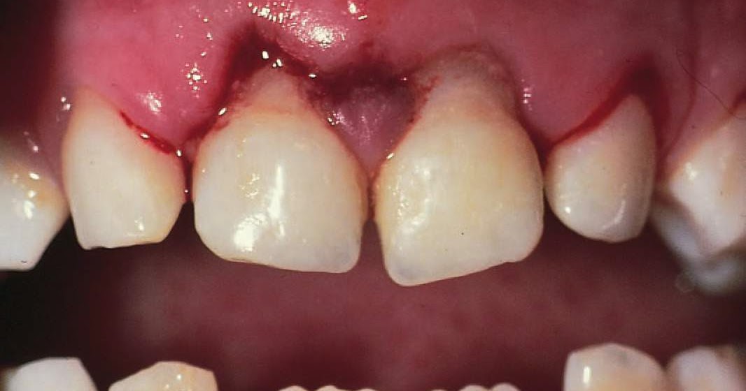 Study Medical Photos: Tooth Subluxation