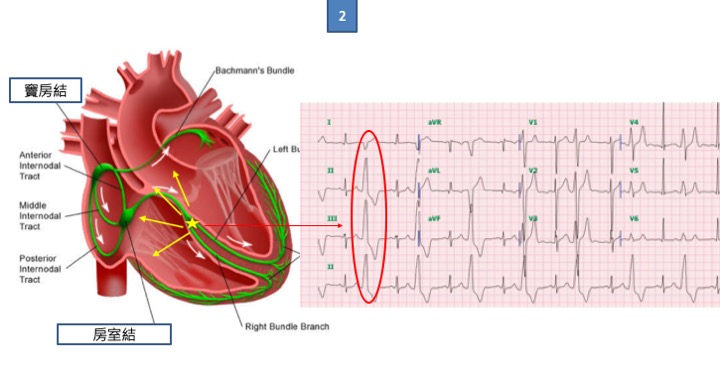 驛動的心跳 林中行醫師 Chung-Hsing Lin, MD: 心室期外收縮VPC是什麼?