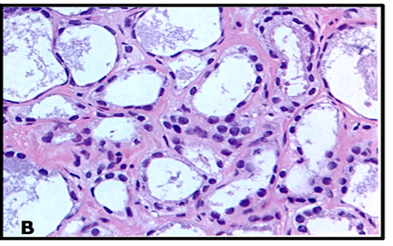 GO BIG or GO HOME: Pathology of prostate gland adenocarcinoma and its ...
