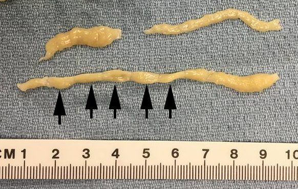 Tapeworm Proglottids In Human Stool