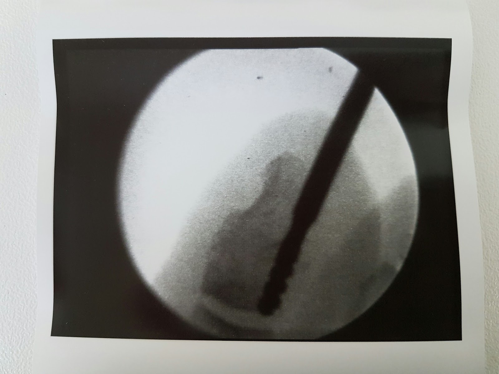 Podo Basas al Día: Operación de heloma interdigital. Ojo de gallo, ojo ...