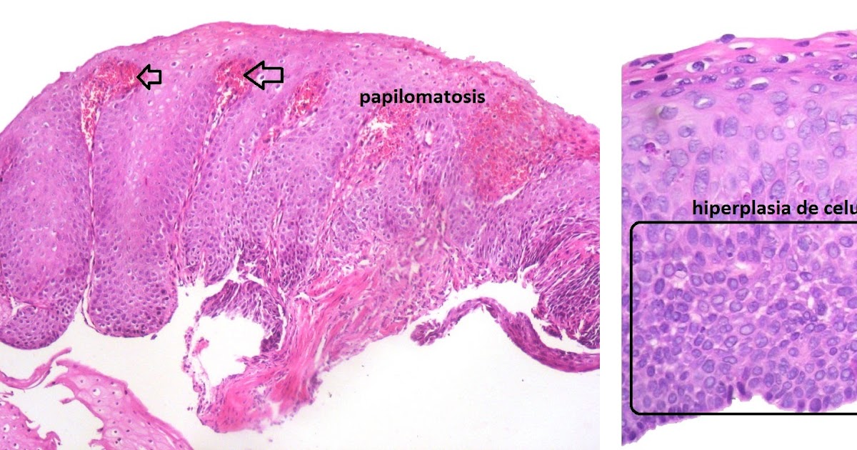 GASTROINTESTINAL AND LIVER HISTOLOGY PATHOLOGY ATLAS: ESOPHAGUS ...