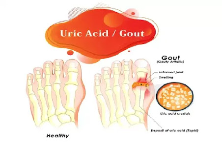 what is Uric Acid and How to control it.