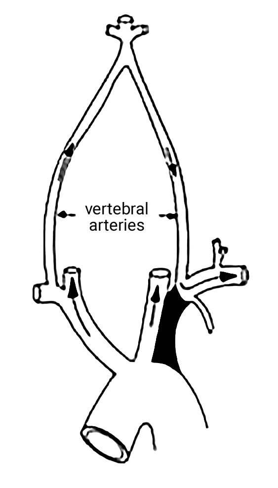 Subclavian steal syndrome - Anesthesiology and Intensive Care