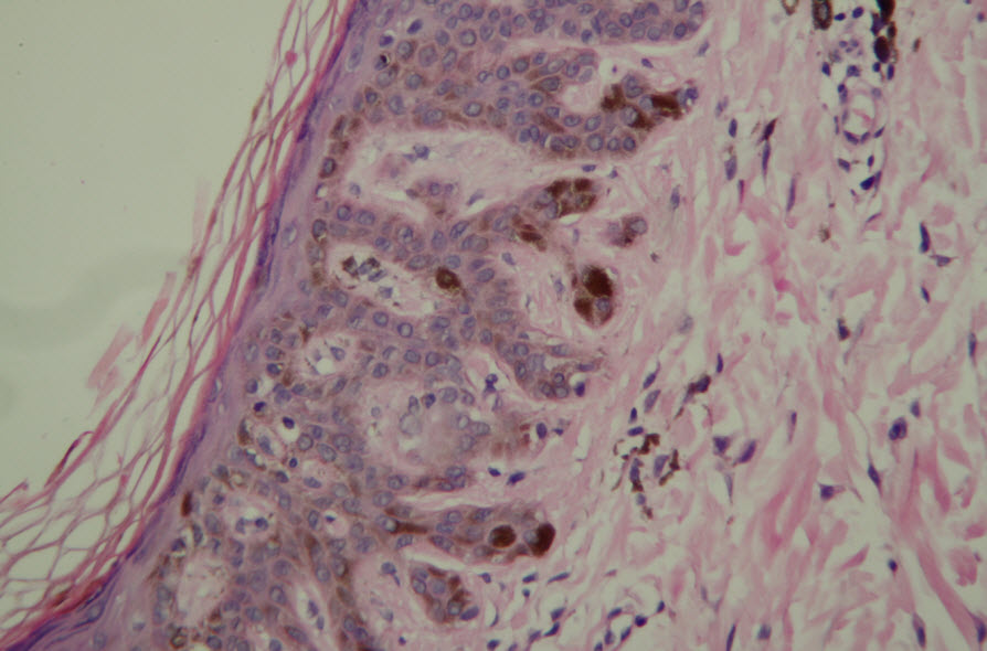 Dermpath Made Simple - Neoplastic: Benign Pigmented Lesions - Solar ...