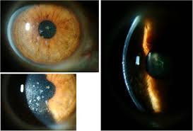 How examine the cornea and its abnormalities