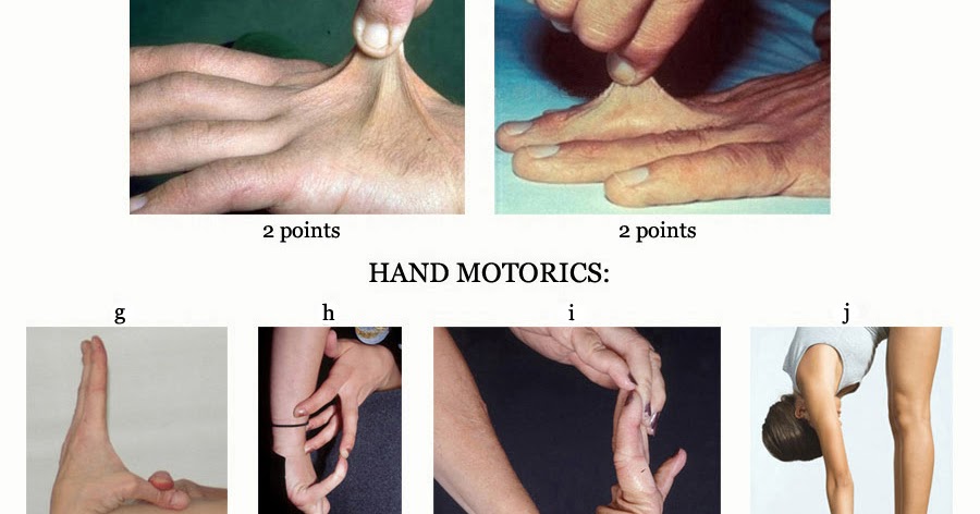 AlexBarbaraMillions: MARFAN SYNDROME? WHAT IS MARFAN SYNDROME?