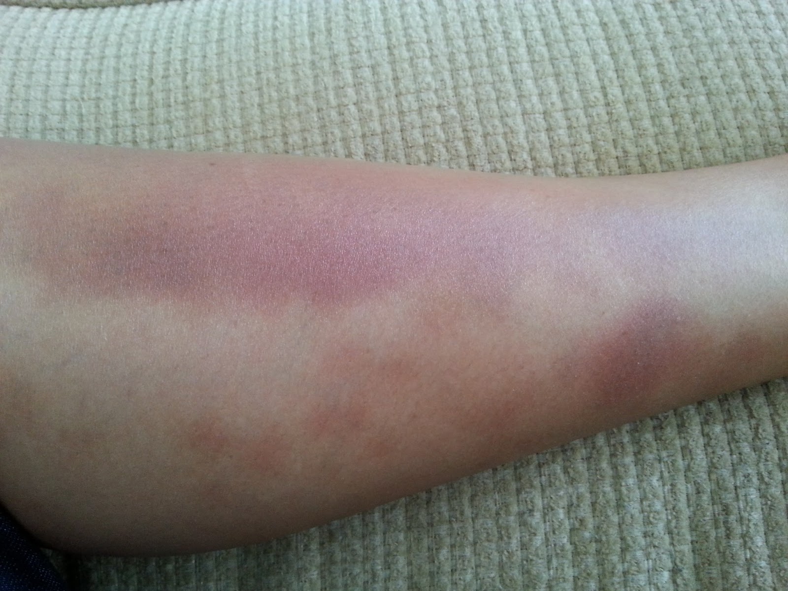 Kim is Obsessed: Graston Technique for Shin Splints