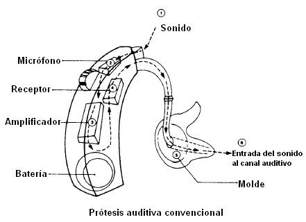 mi experiencia con un Implante Coclear: LA PRÓTESIS AUDITIVA ...
