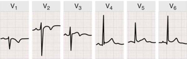ECG T wave changes and interpretation