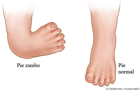 Cirugía Ortopédica y Traumatología Avanzada - Dr. Ricardo Casal: Pie zambo