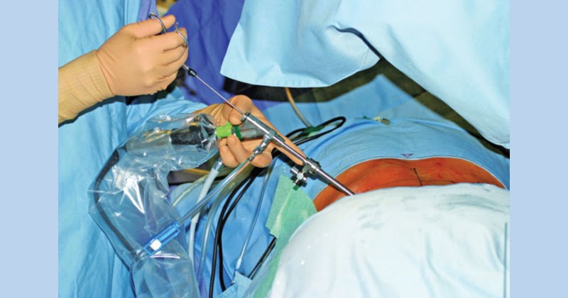 Endoscopic Discectomy: Surgery, Surgeon, Hospitals & Procedure - List ...