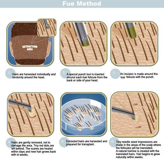 Latest techniques in Hair Transplantation - Best Hair Transplants