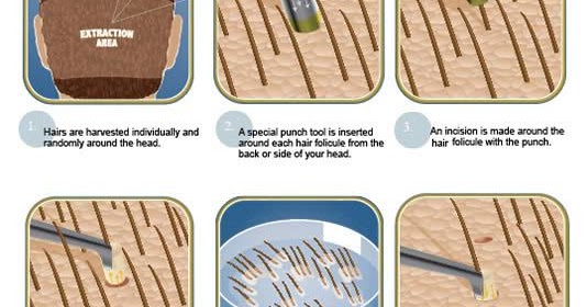 Latest techniques in Hair Transplantation - Best Hair Transplants