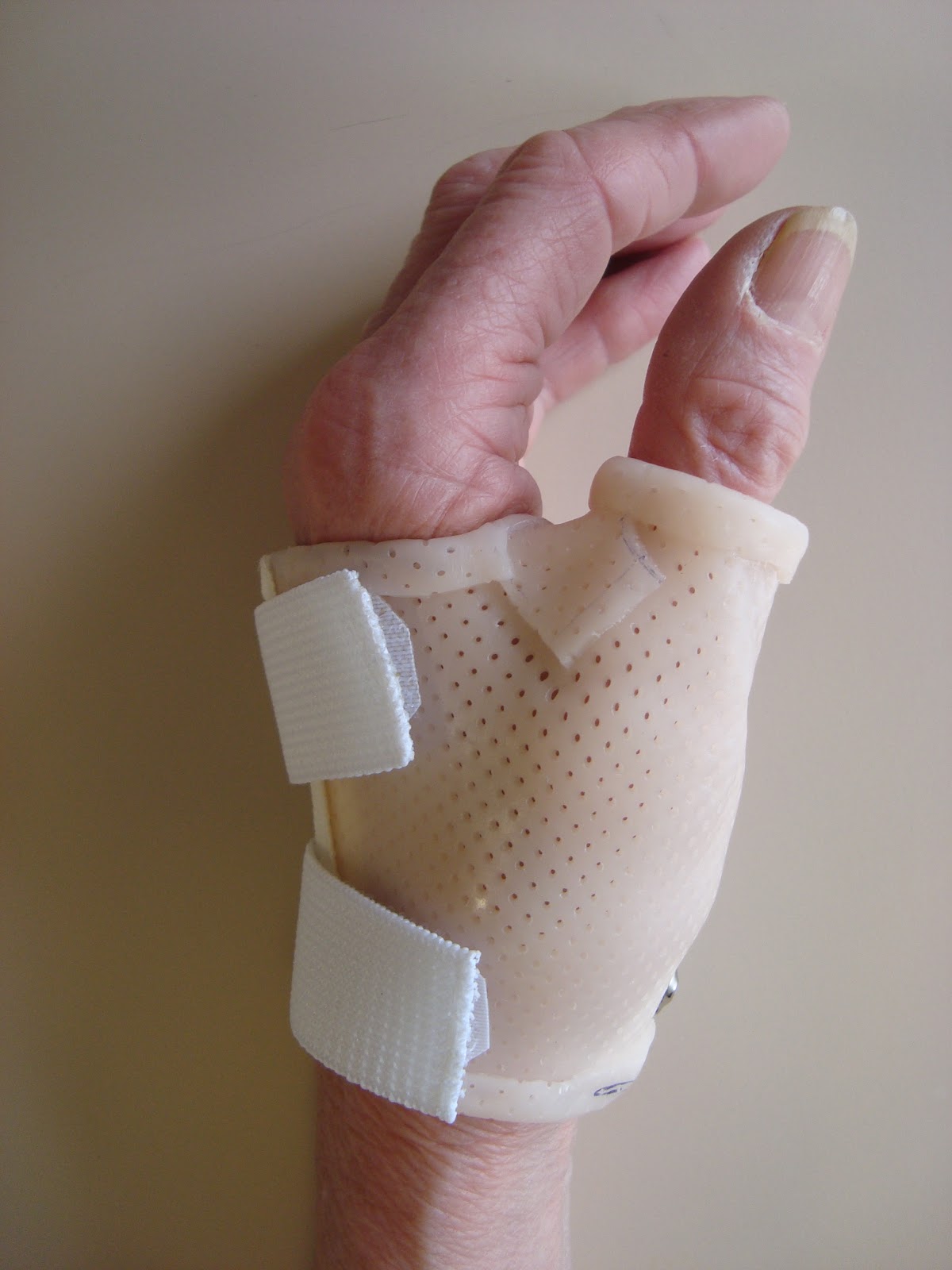 Orthèses sur mesure et appareillage personnalisé main poignet doigts ...