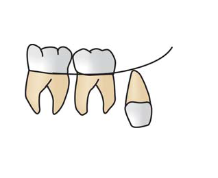 Classification of impacted mandibular third molar